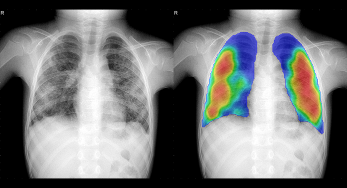 Our improved CAD4TB software is now reliable for children - Delft Imaging