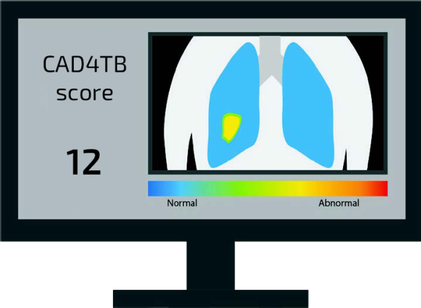 CAD4TB: AI-Powered Tuberculosis Detection Software